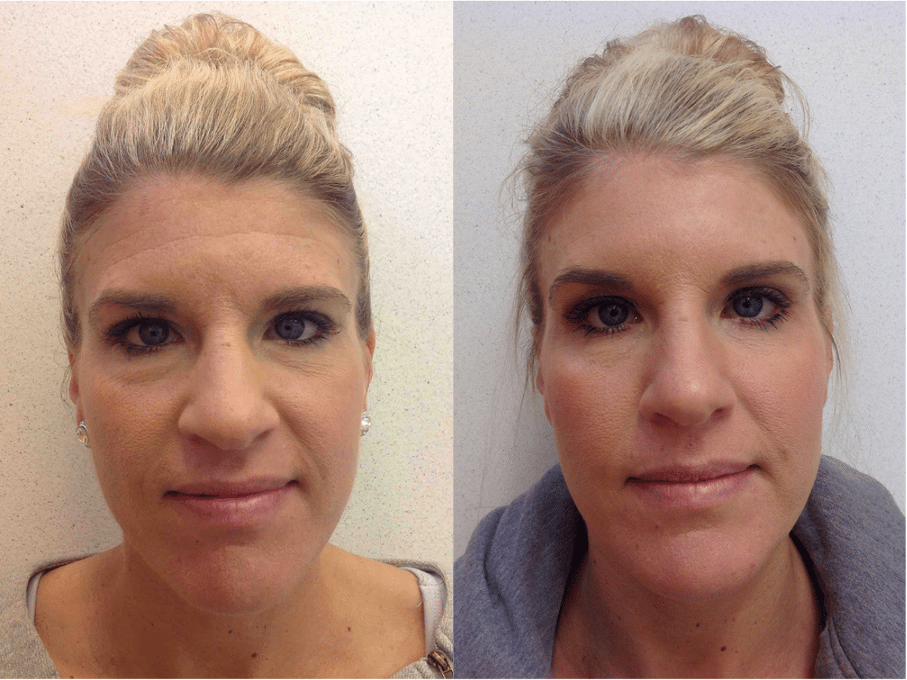 Wrinkle Relaxers | Schlessinger MD