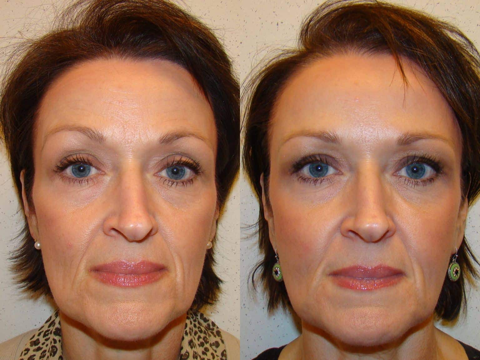 BOTOX - Before & Afters