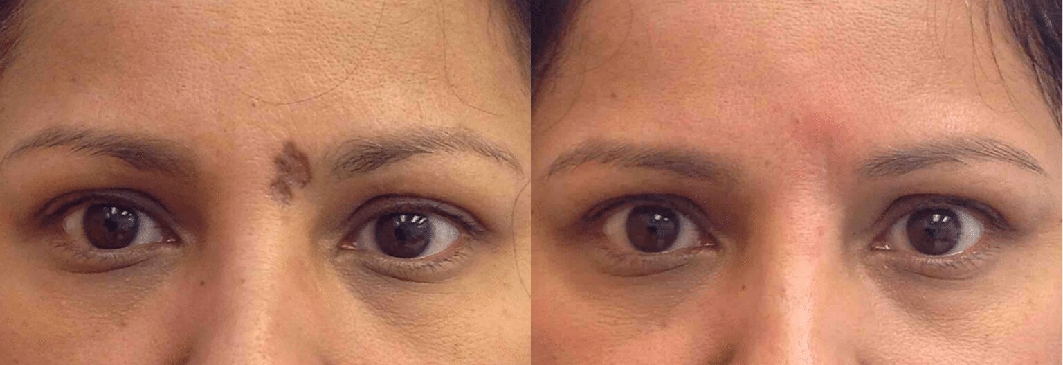 Scar Treatment Before & After Pictures | Schlessinger MD
