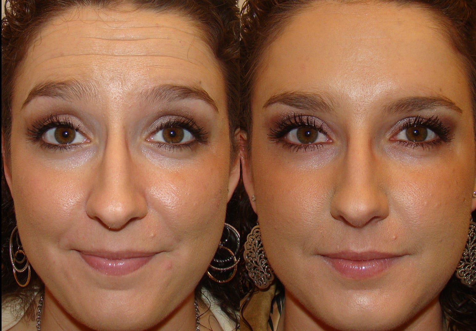 Can BOTOX® prevent wrinkles? | Schlessinger MD